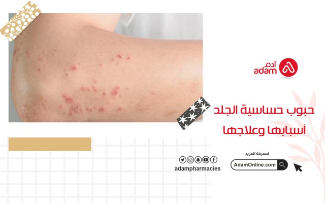 Adam Pharmacies | Skin allergy pills causes and treatment