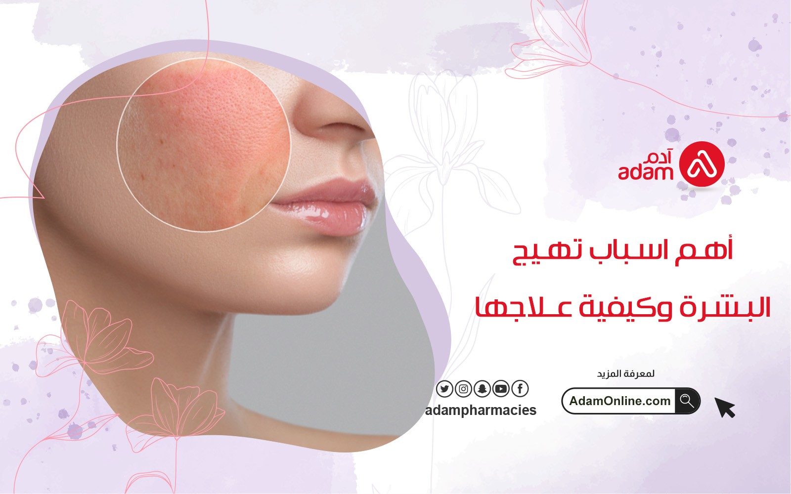 Adam Pharmacies | Irritation of the skin