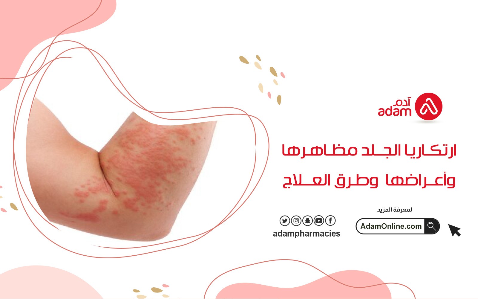 Adam Pharmacies | Skin urticaria, its manifestations, symptoms and ...